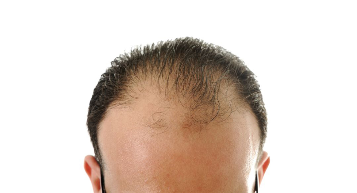 De 7 allergrootste voordelen van kaal worden | Kakhiel